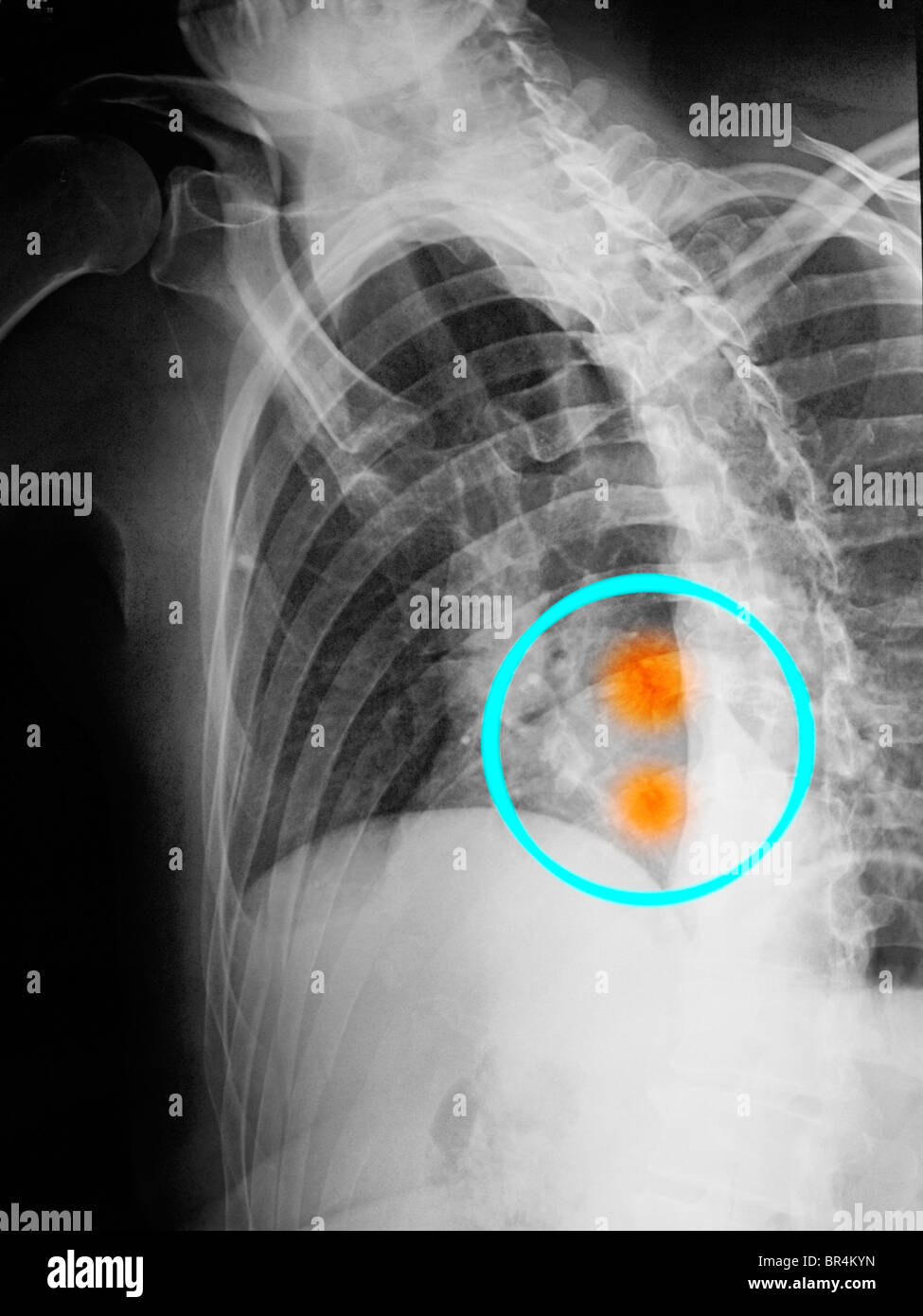 Radiographie montrant fractures aux côtes d'un homme âgé de 64 ans ...
