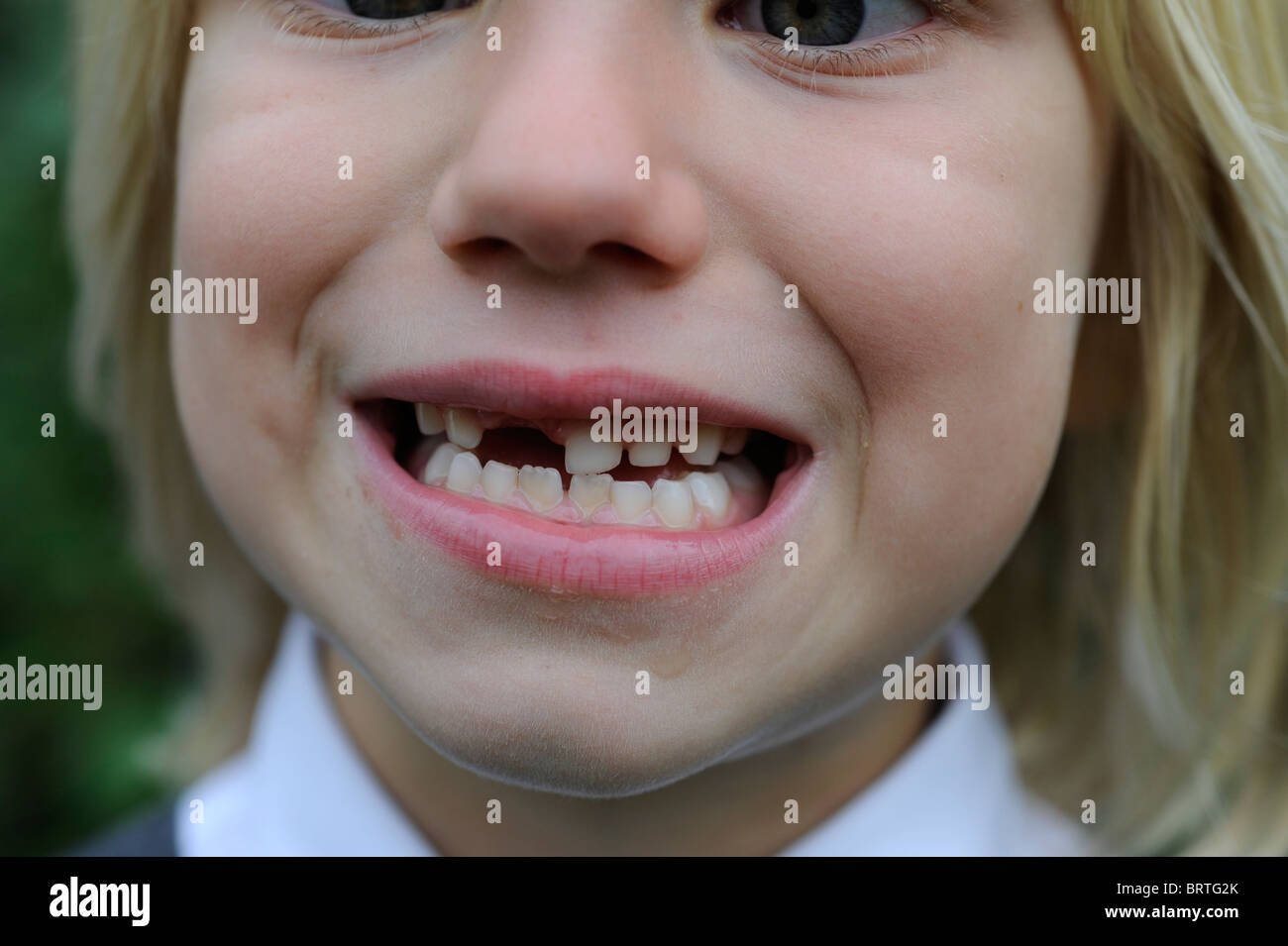 Tooth decay child Banque de photographies et d’images à haute résolution - Page 2 - Alamy