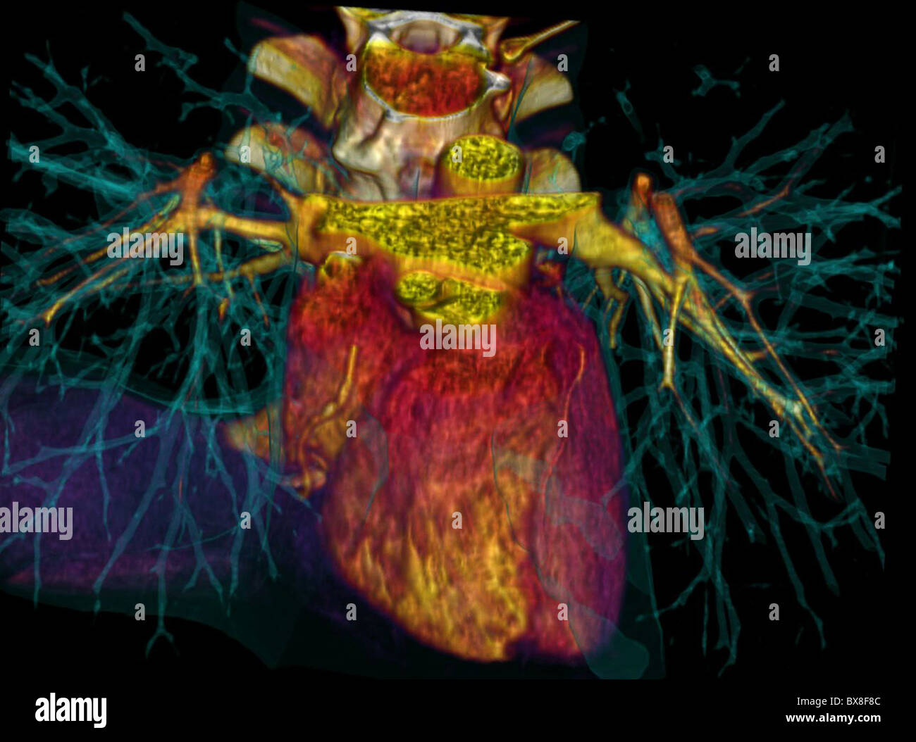 Scintigraphie cardiaque Banque de photographies et d’images à haute ...
