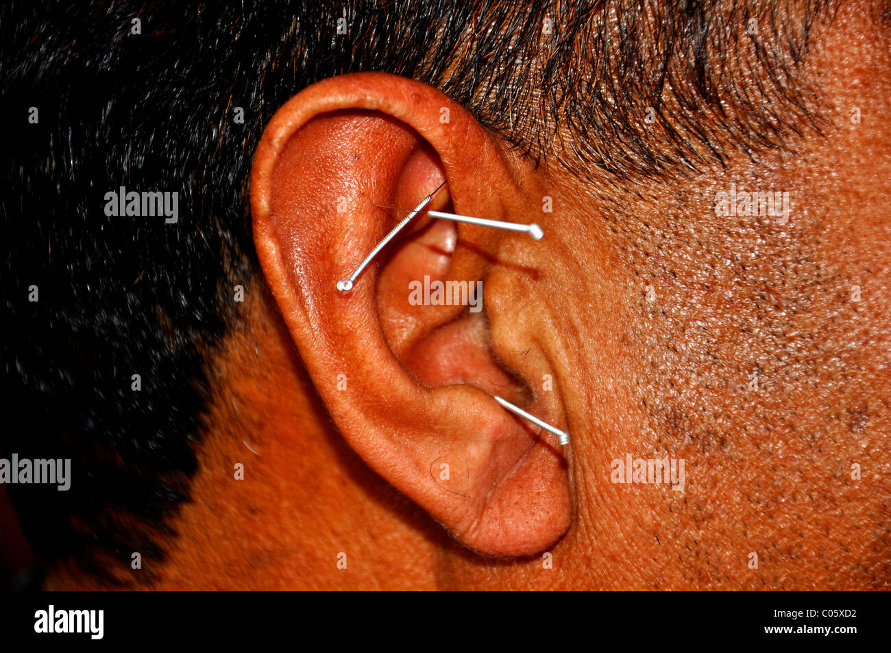 Ear Acupuncture Banque d'image et photos - Alamy