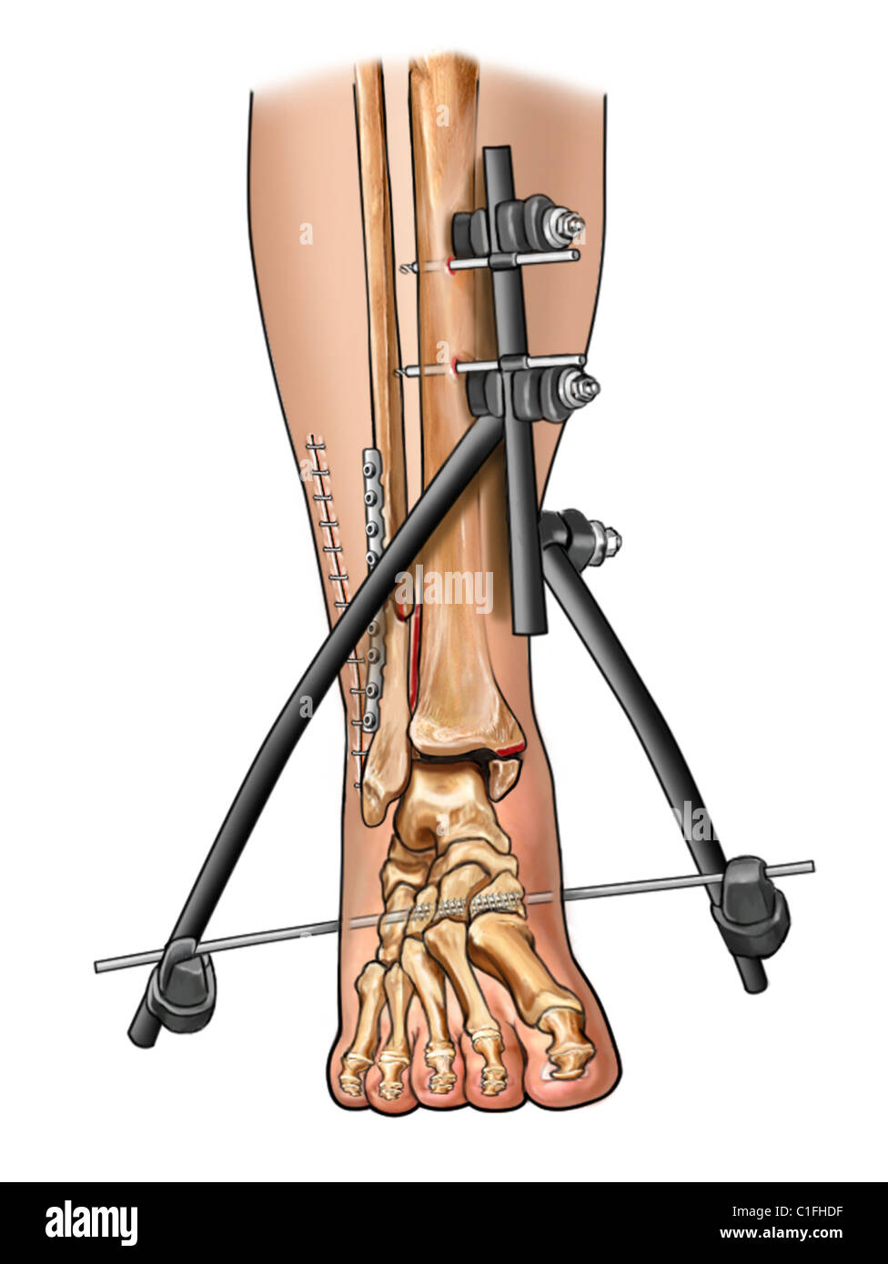 Cette figure illustre les fixation chirurgicale d'une fracture du ...