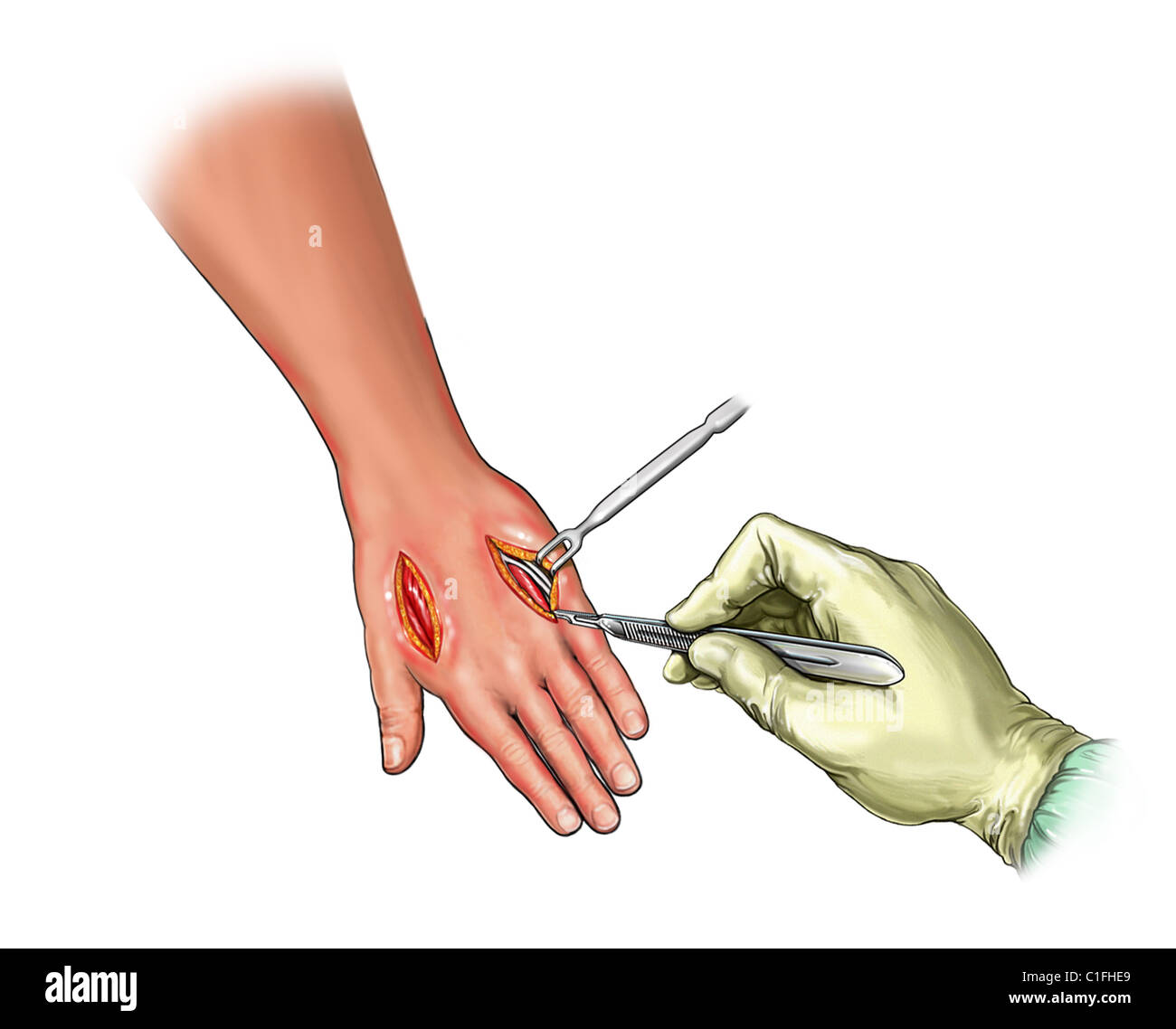 Compartment syndrome Banque de photographies et d’images à haute ...