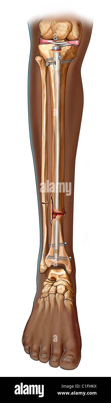 Cette illustration médicale illustre du péroné tibial fixation Photo ...
