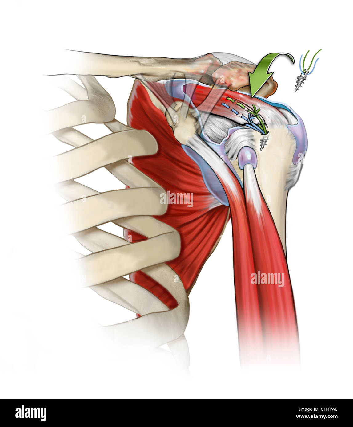 Rotator cuff repair Banque de photographies et d’images à haute ...