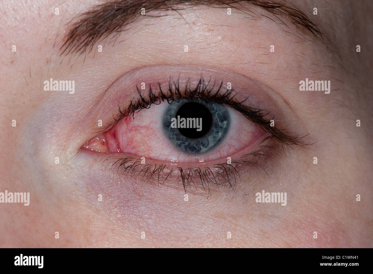 Bacterial conjunctivitis Banque de photographies et d’images à haute ...