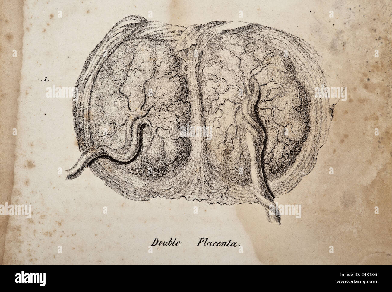 Placenta humain placenta humain Banque de photographies et d’images à ...