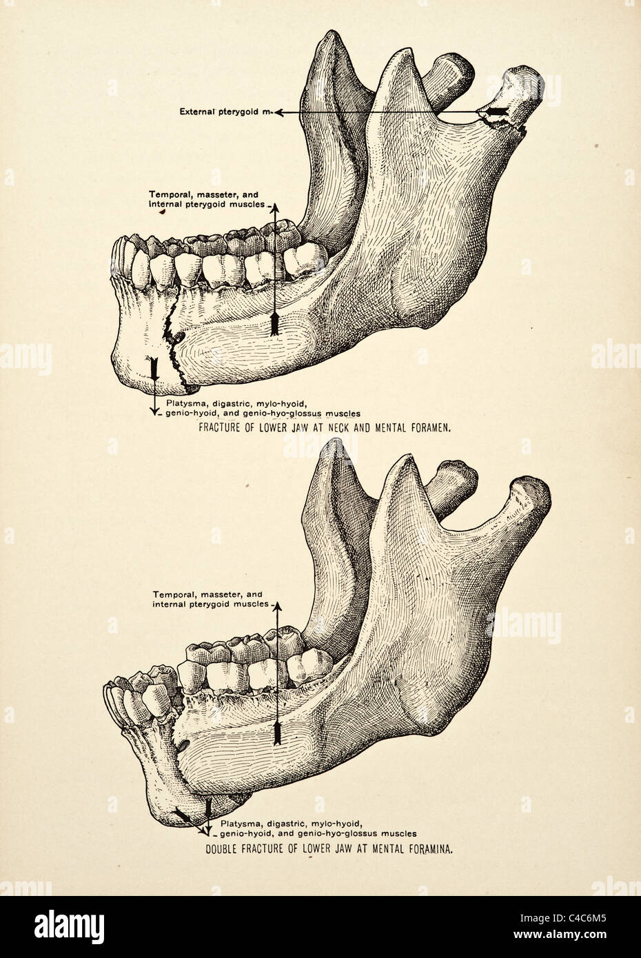 Os zygomatique Banque de photographies et d’images à haute résolution ...