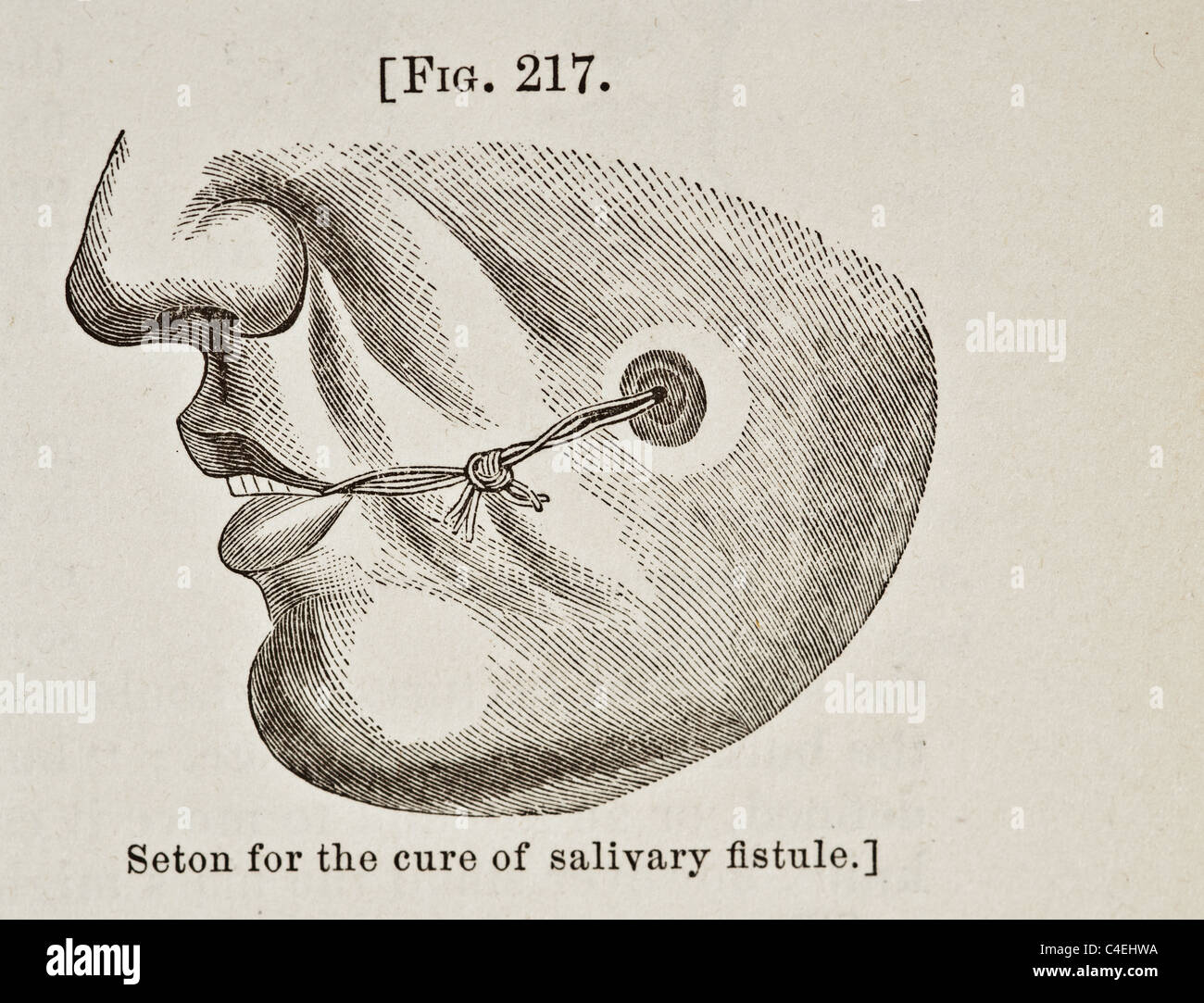 Drain chirurgical Banque de photographies et d’images à haute ...