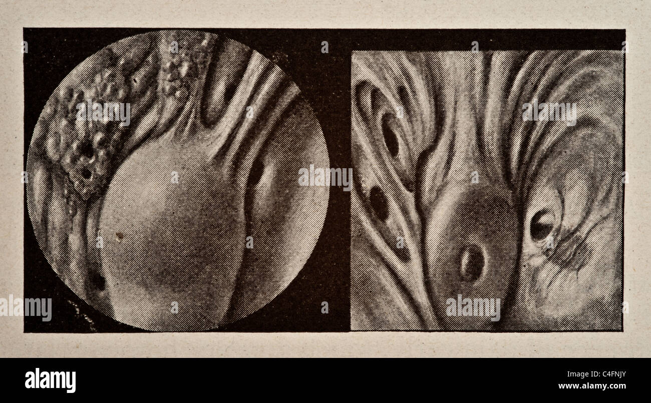 Urologie - Hommes, femmes et enfants par Victor Pedersen copyright 1919 ...