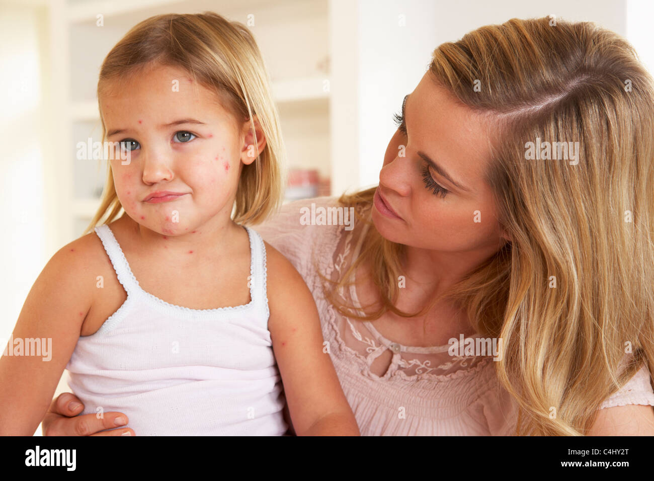 Enfant Avec Varicelle Banque d'image et photos - Alamy