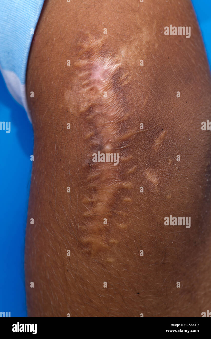 Scar surgery Banque de photographies et d’images à haute résolution - Alamy