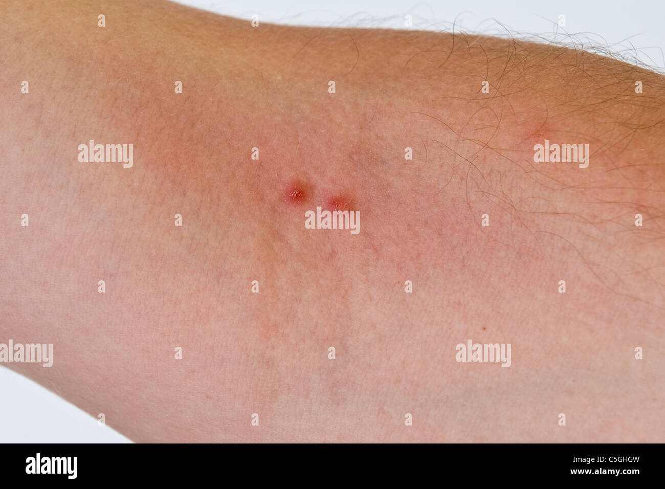 les piqûres d’insectes Photo Stock - Alamy
