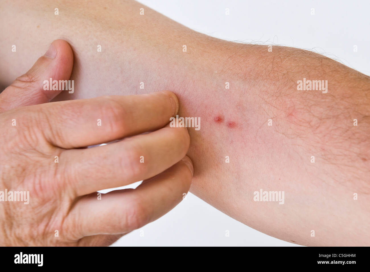 Morsures d'insecte Banque de photographies et d’images à haute ...
