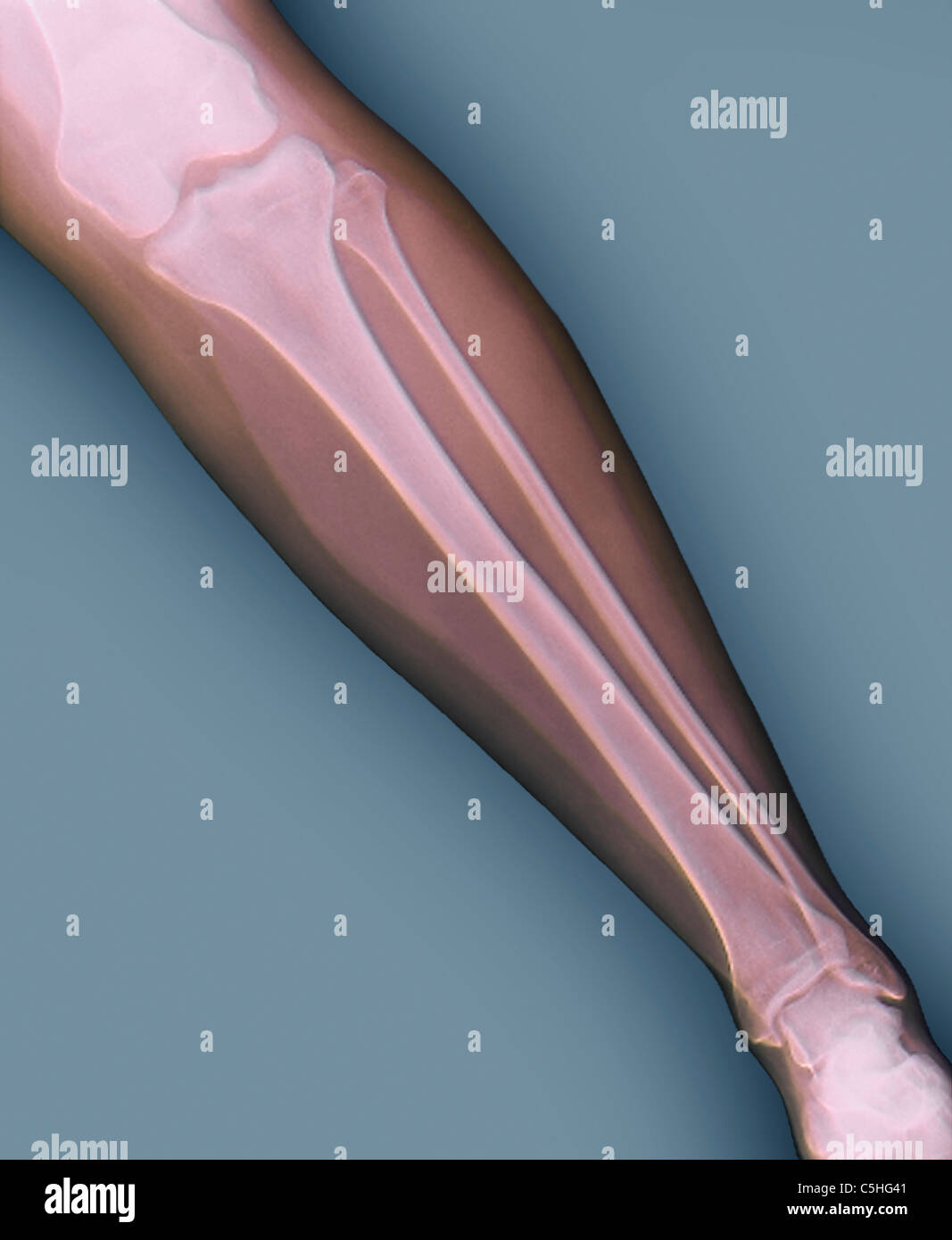 La normale jambe inférieure, X-ray Photo Stock - Alamy