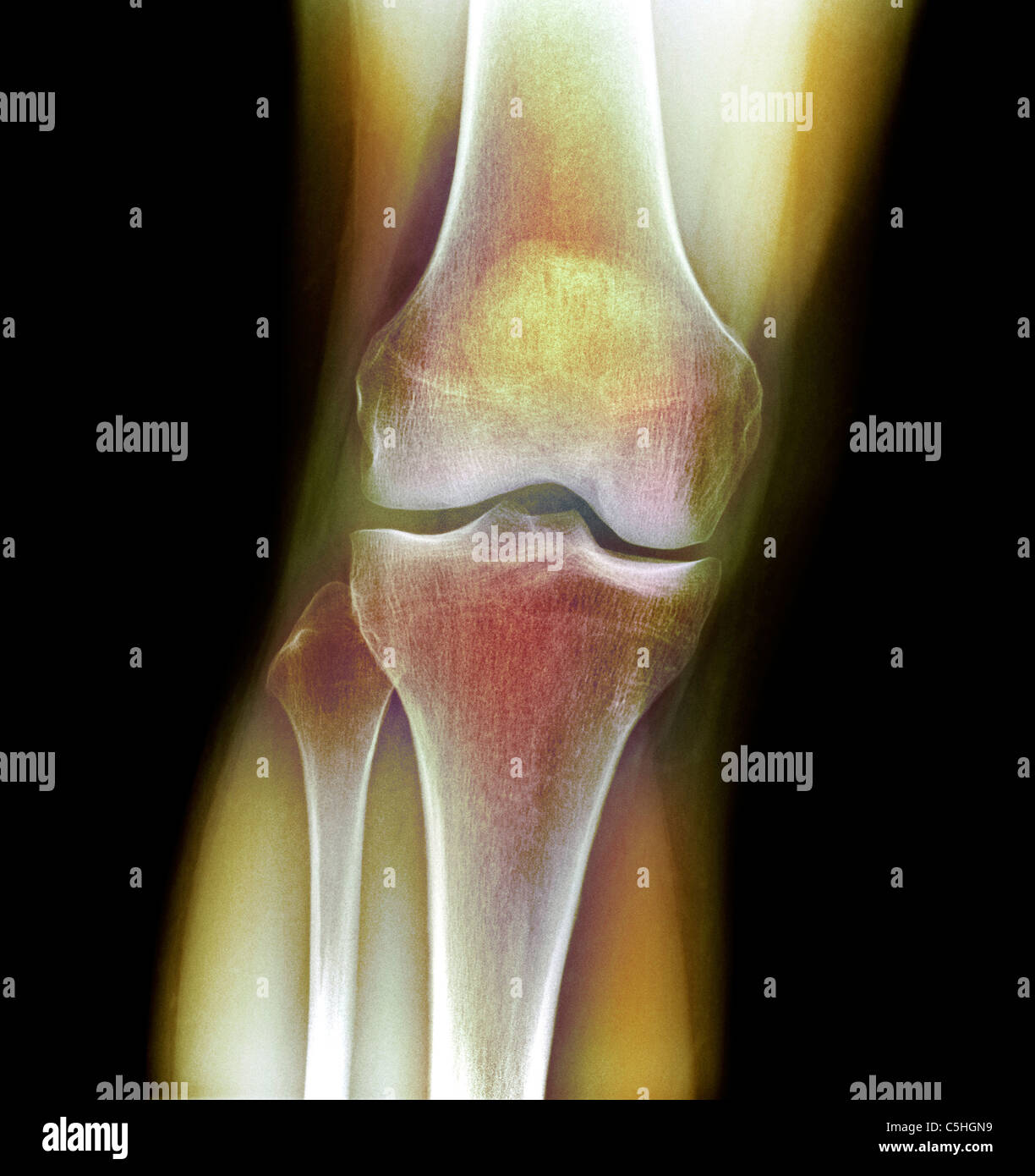 Genoux normaux Banque de photographies et d’images à haute résolution ...