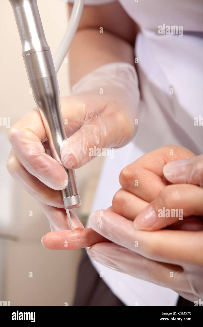 élimination de la peau des verrues Banque de photographies et d’images ...