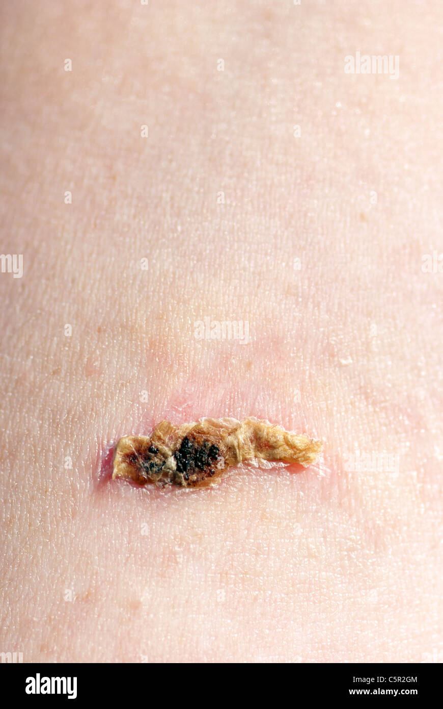 Bite wound human Banque de photographies et d’images à haute résolution ...