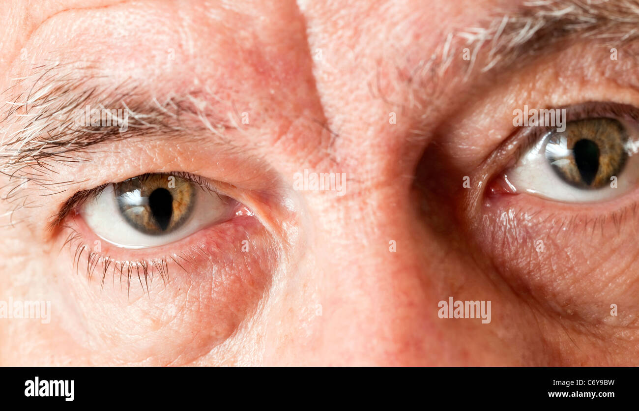 Extrêmement rares le colobome symétrique Photo Stock - Alamy