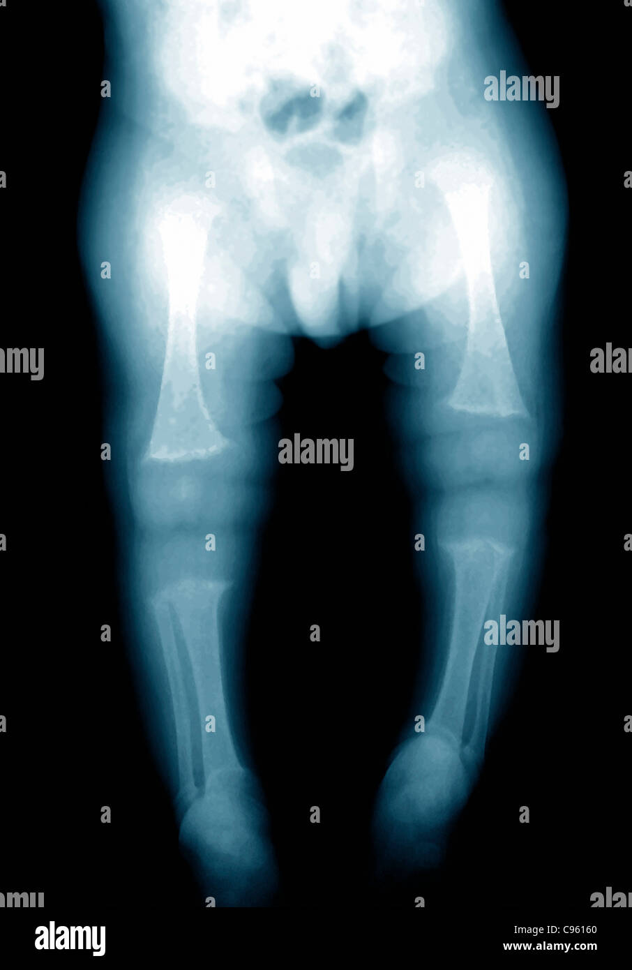 Rickets x ray Banque de photographies et d’images à haute résolution ...