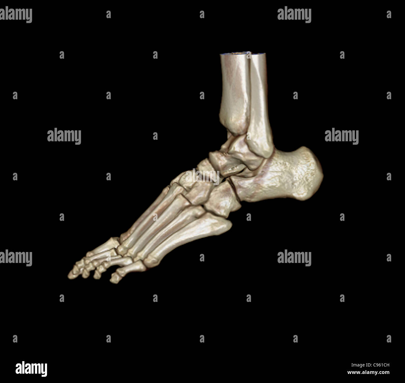 Pied normal. 3D couleur tomodensitométrie (TDM) du pied en bonne santé ...