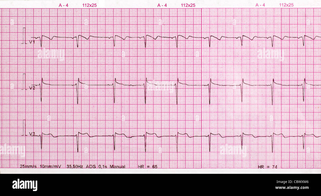 Trace ecg Banque de photographies et d’images à haute résolution - Alamy