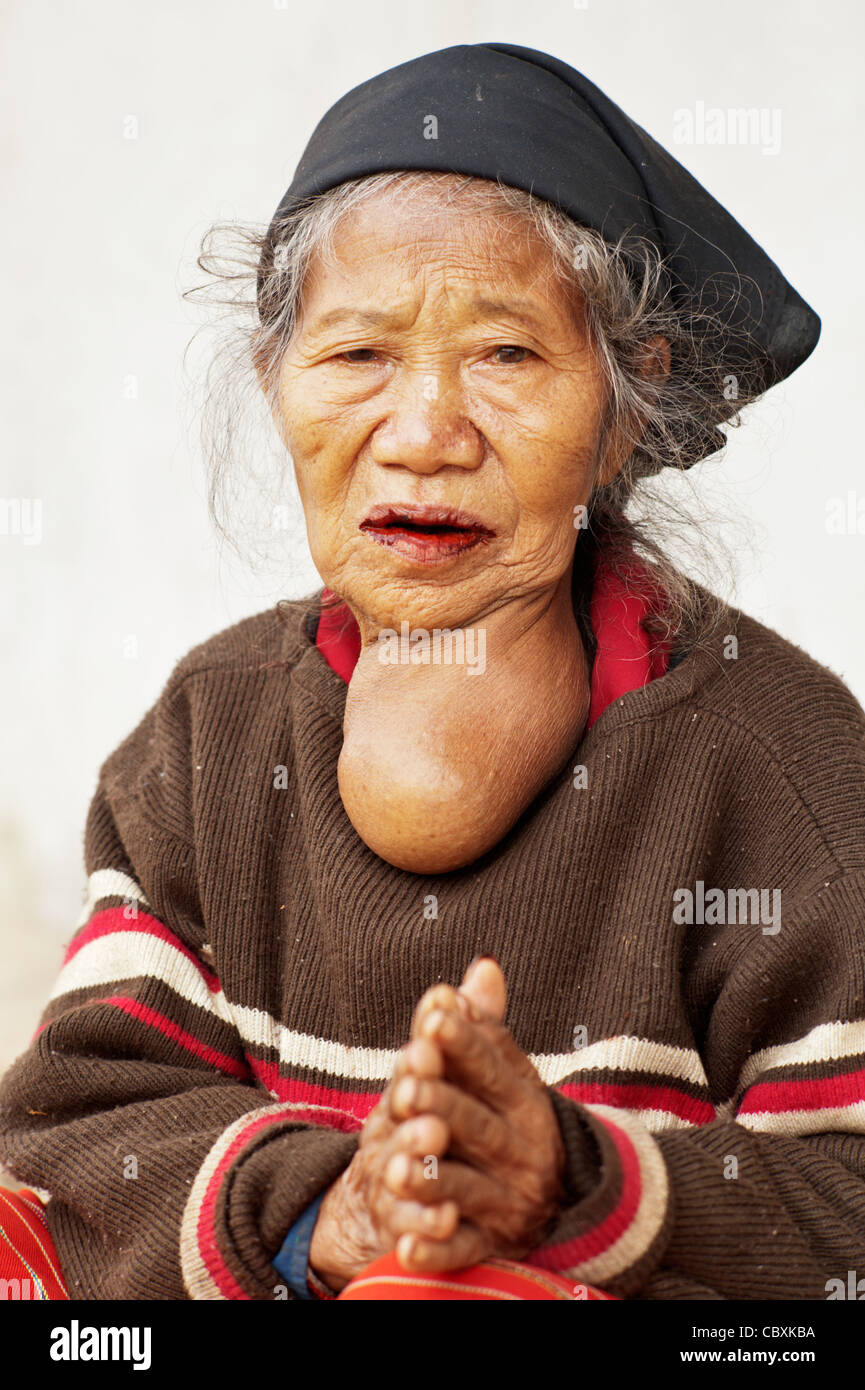 Goiter woman Banque de photographies et d’images à haute résolution - Alamy