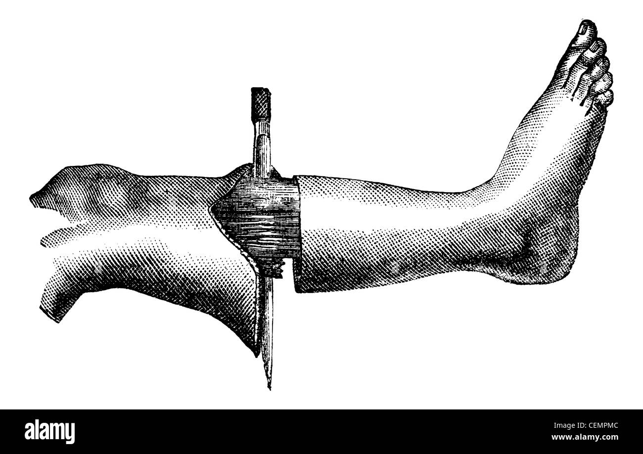 L'amputation de la jambe par la méthode a deux volets (incision ...