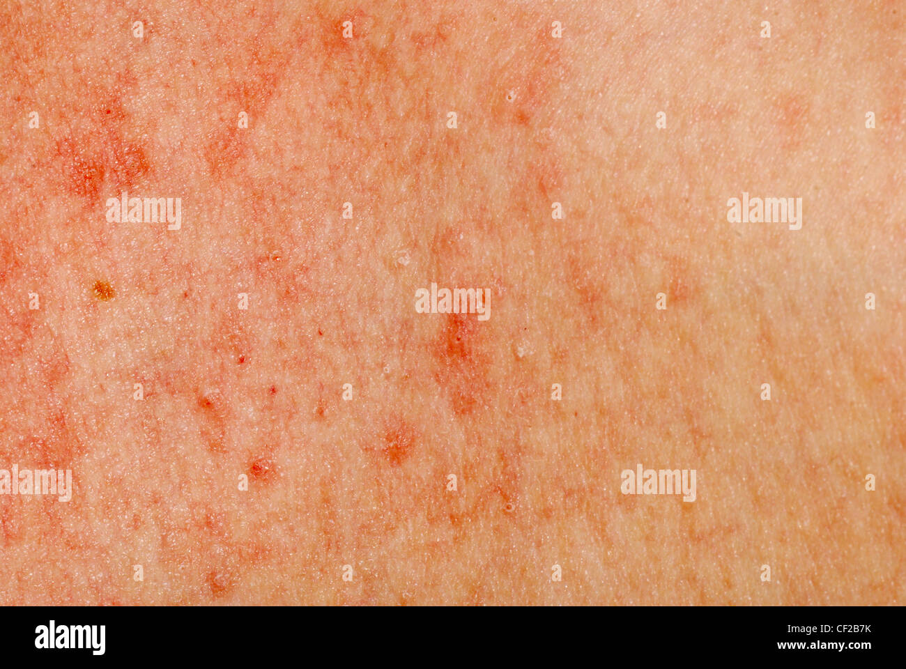 Éruption allergique Dermatite atopique la texture de la peau du patient ...