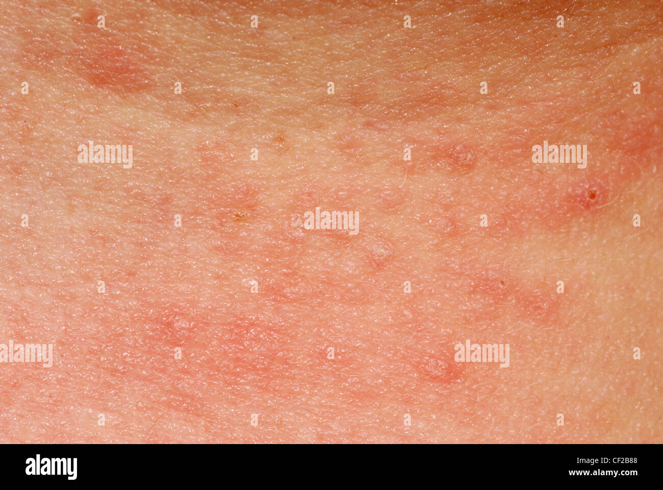 Éruption allergique Dermatite atopique la texture de la peau du patient ...