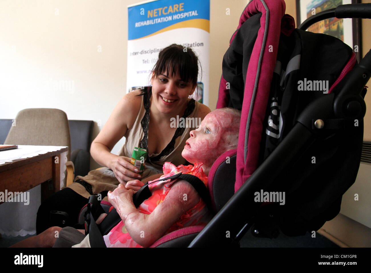 Brûlure au troisième degré Banque de photographies et d’images à haute ...