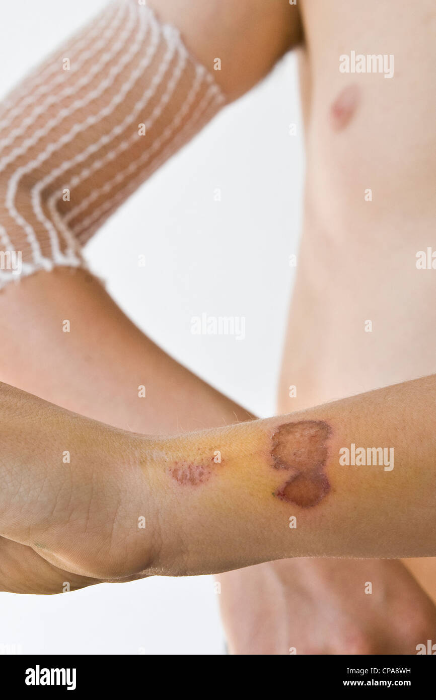 Plaie saignante bras Banque de photographies et d’images à haute ...