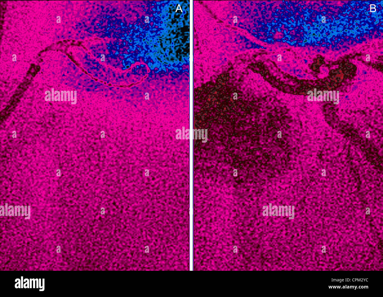 Dilatation des vaisseaux sanguins Banque de photographies et d’images à ...