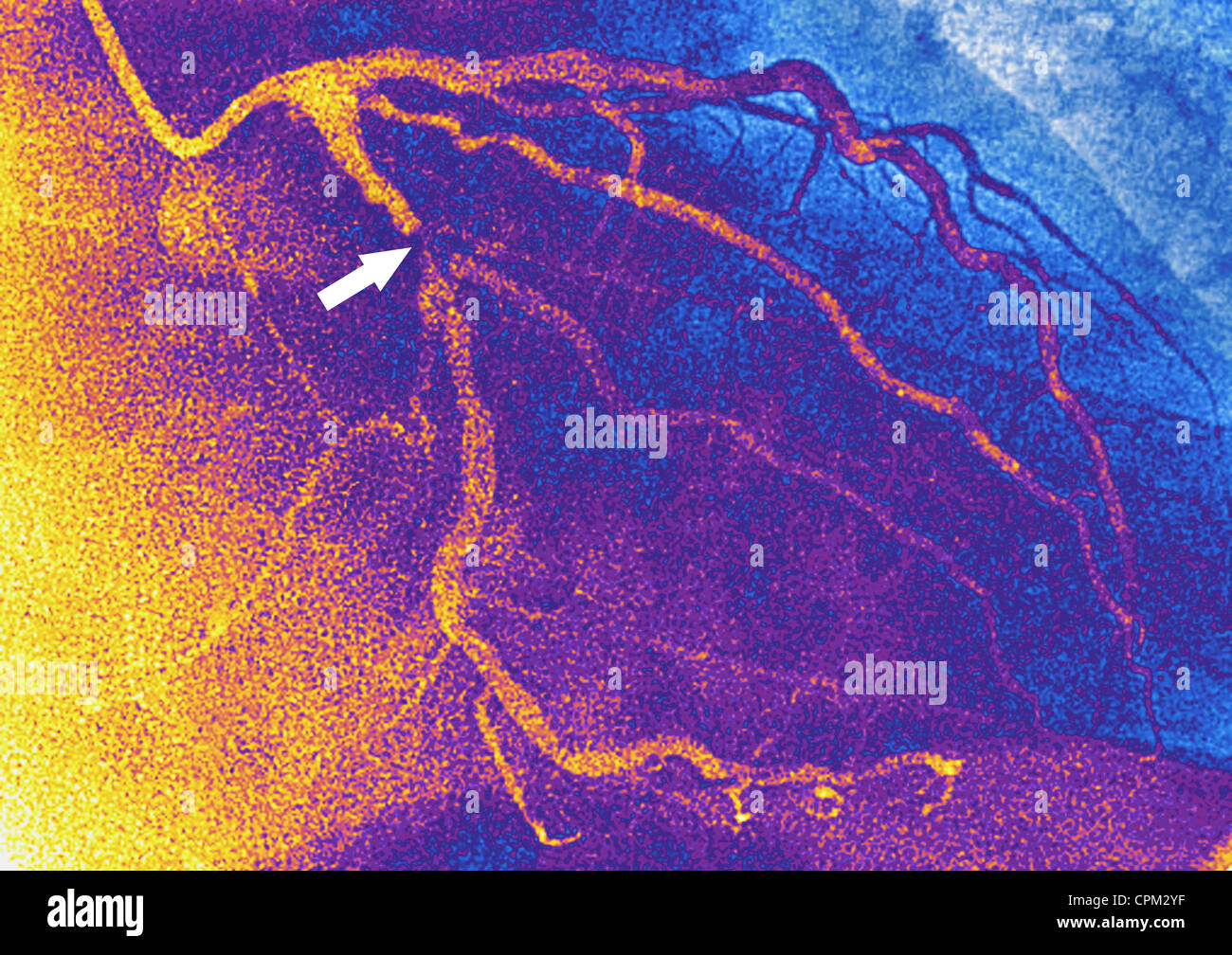 Infarctus du myocarde, ANGIOGRA Photo Stock - Alamy