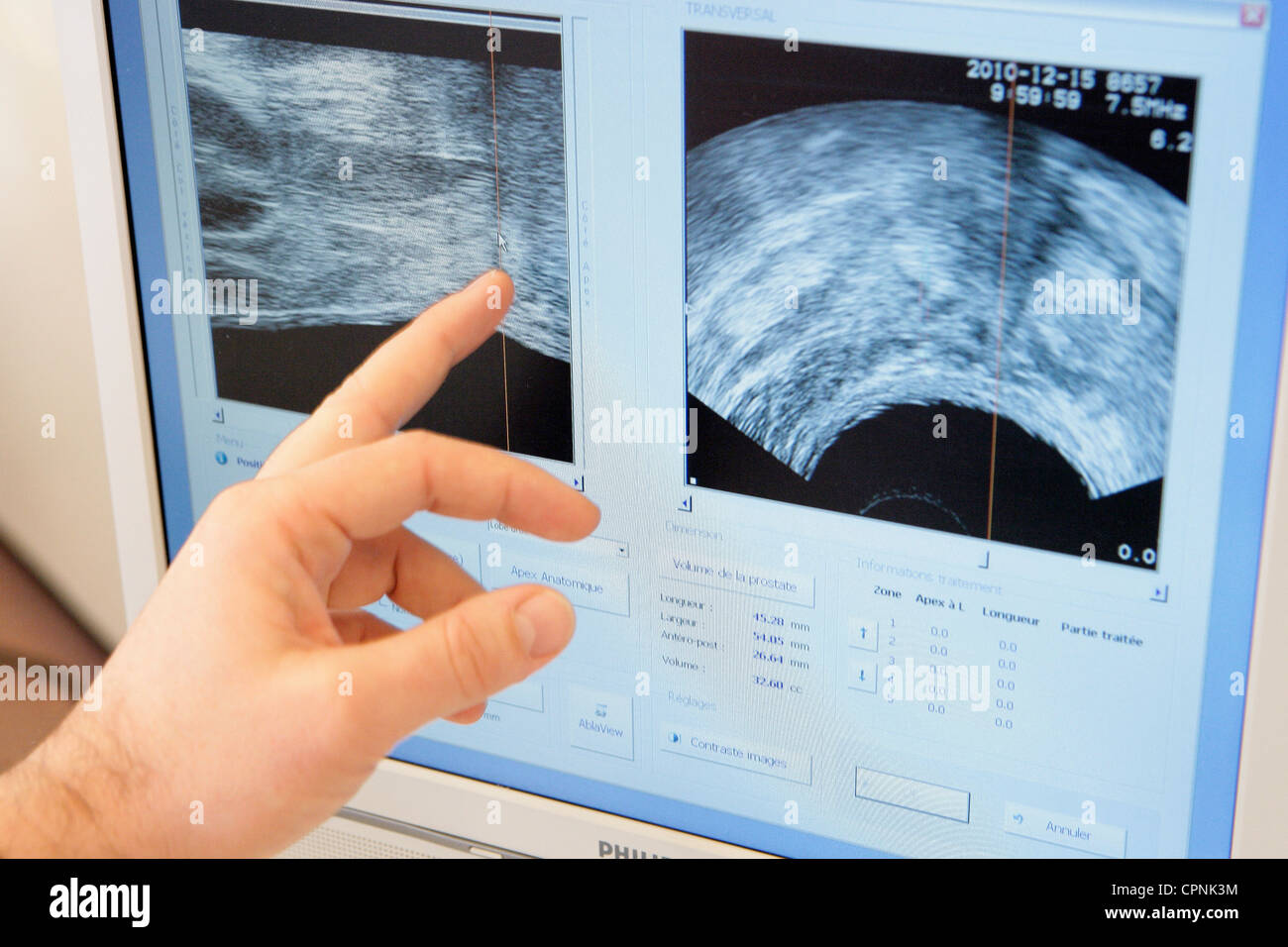 échographie prostate cancer Banque de photographies et d’images à haute résolution - Alamy