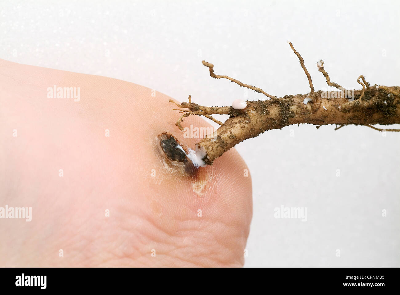 Verrues cutanées Banque de photographies et d’images à haute résolution ...