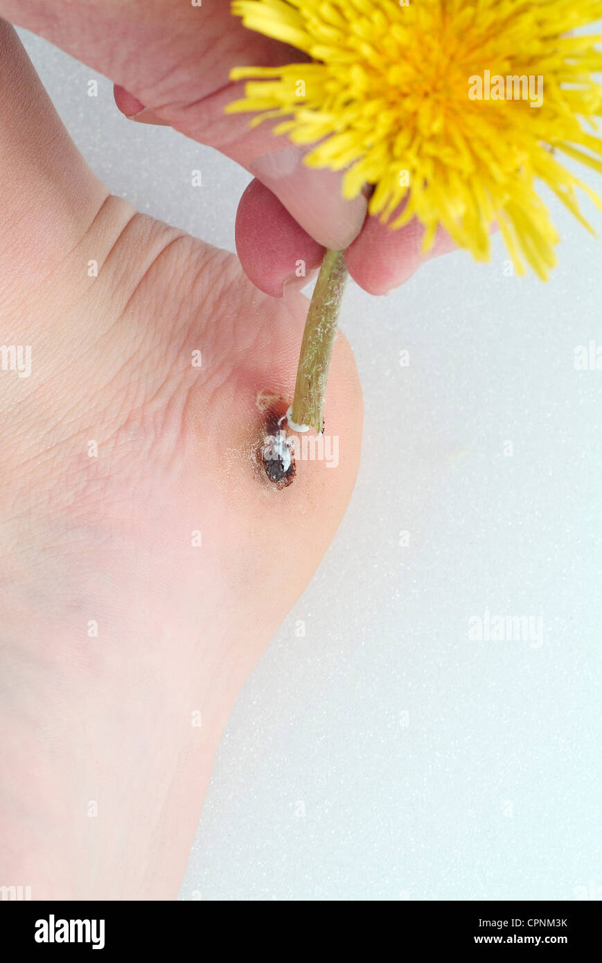 TRAITEMENT DES VERRUES Photo Stock - Alamy