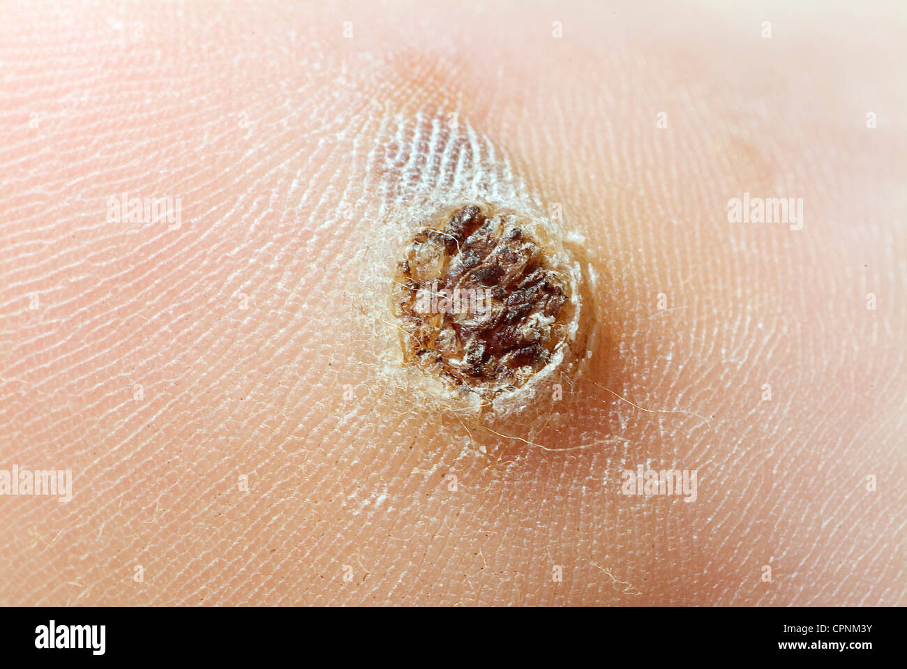 Verrues Cutanées Banque d'image et photos - Alamy