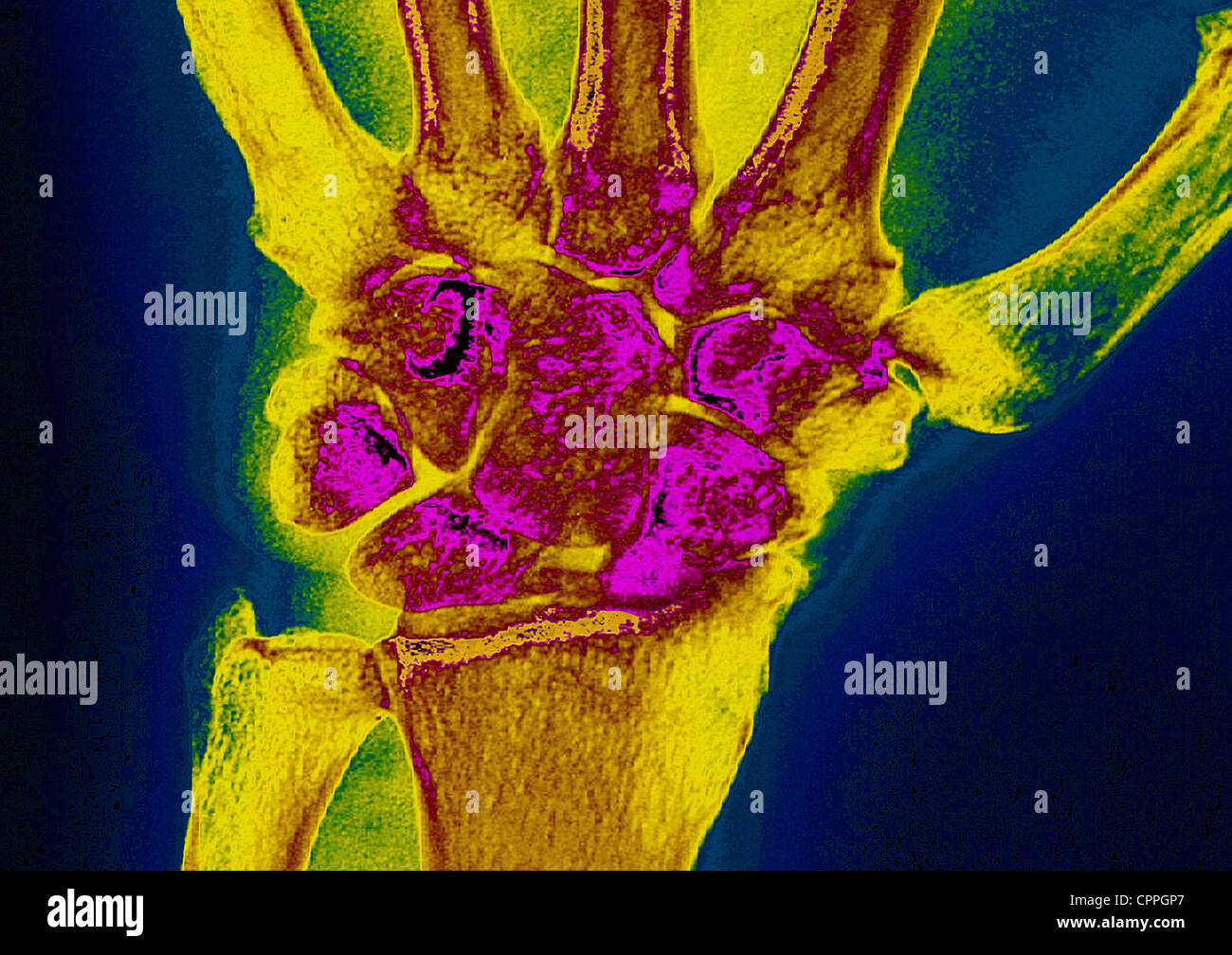 Arthrose du poignet Banque de photographies et d’images à haute ...