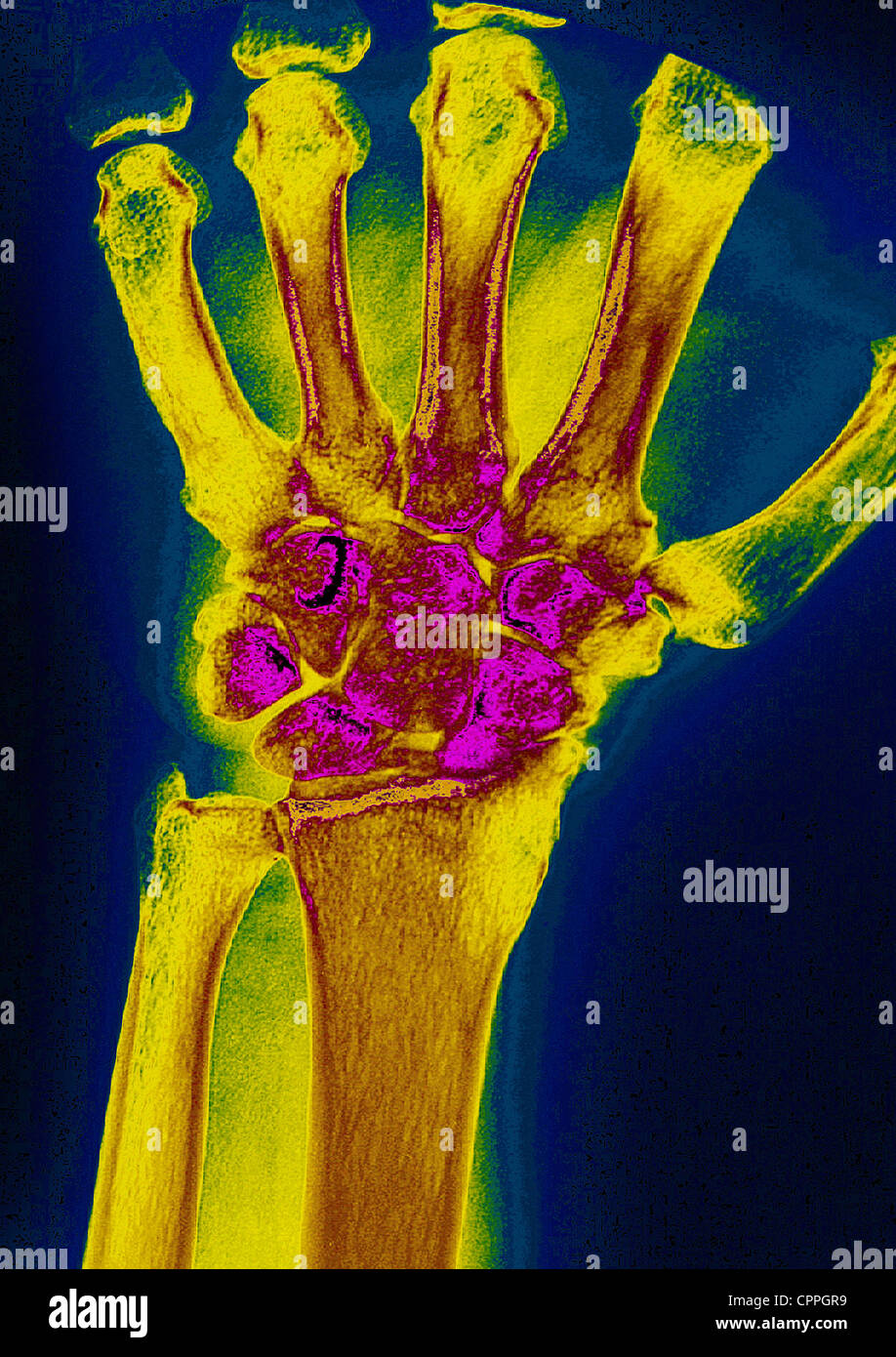 Arthrose du poignet Banque de photographies et d’images à haute ...