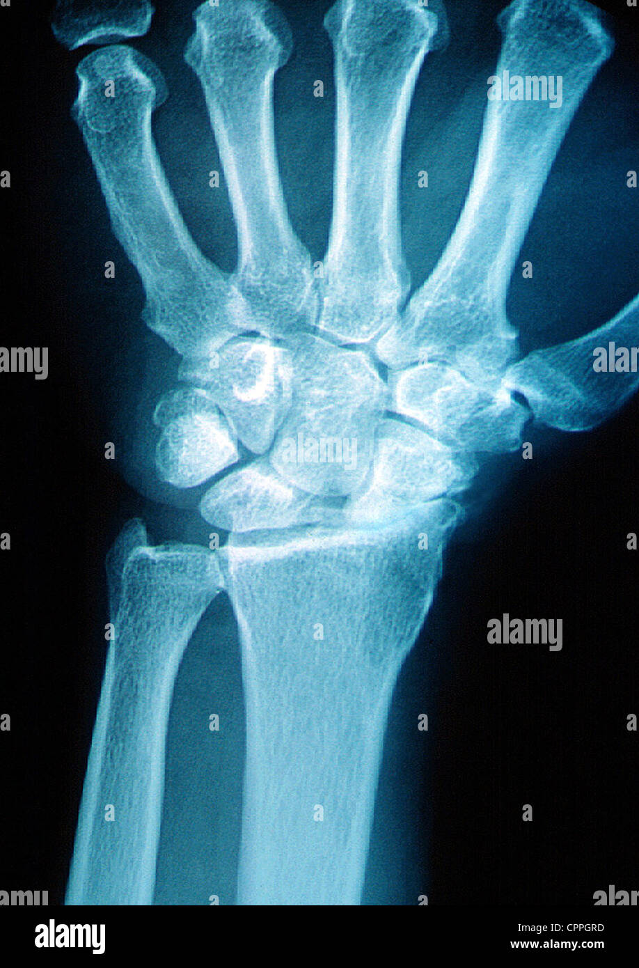 Arthrose Du Poignet Banque d'image et photos - Alamy