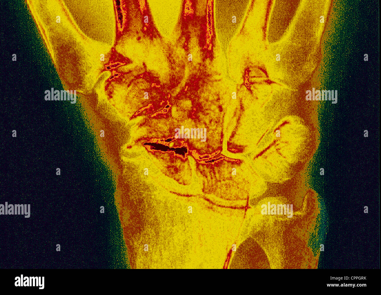 Arthrose du poignet Banque de photographies et d’images à haute ...