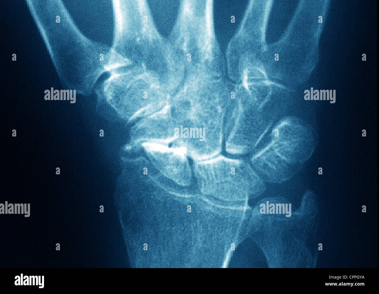Radiographie des mains arthrose Banque de photographies et d’images à ...