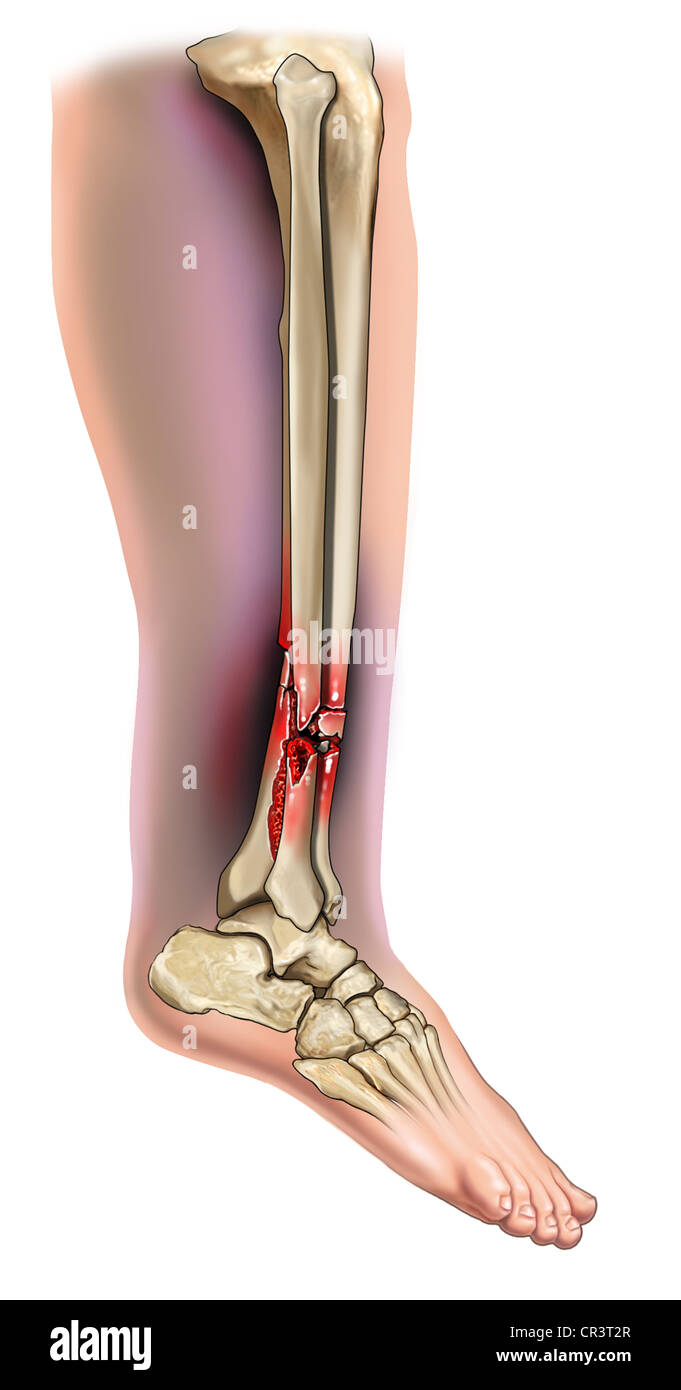 Fracture Dislocation Photos & Fracture Dislocation Images - Alamy