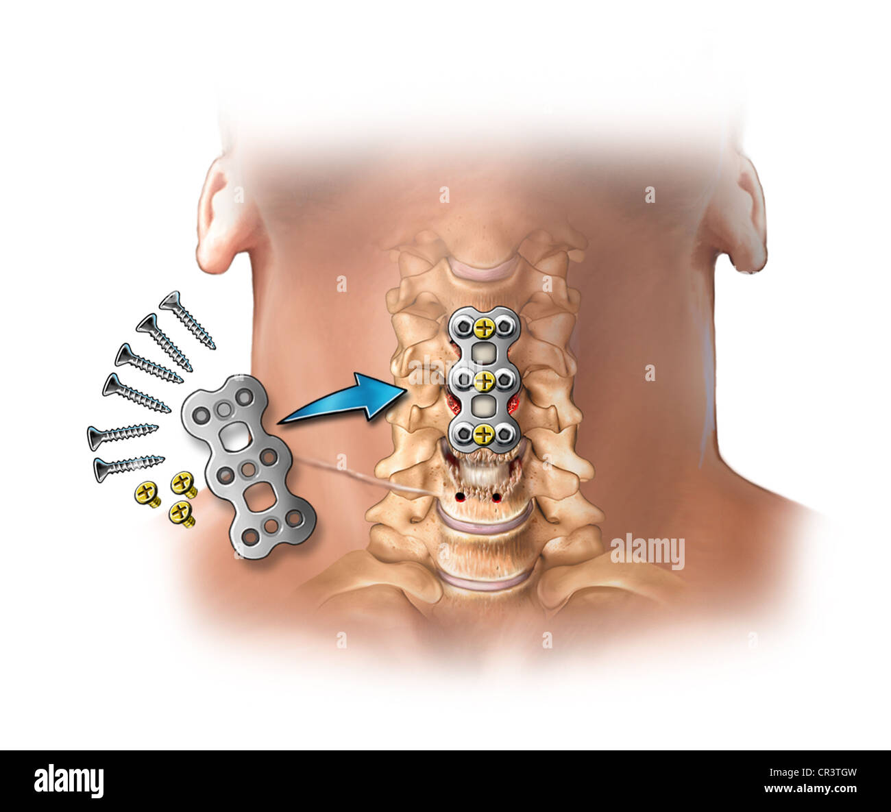 C3 4 C4 5 C5 6 Fusion Osseuse Condition Post Opératoire Photo Stock