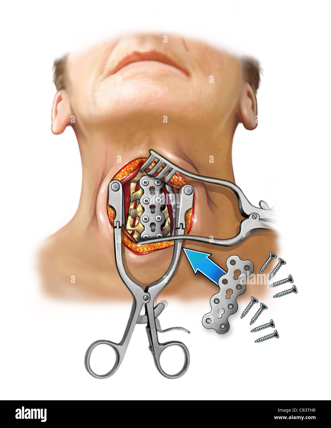 Cervical Bone Fusion Banque d'image et photos - Alamy