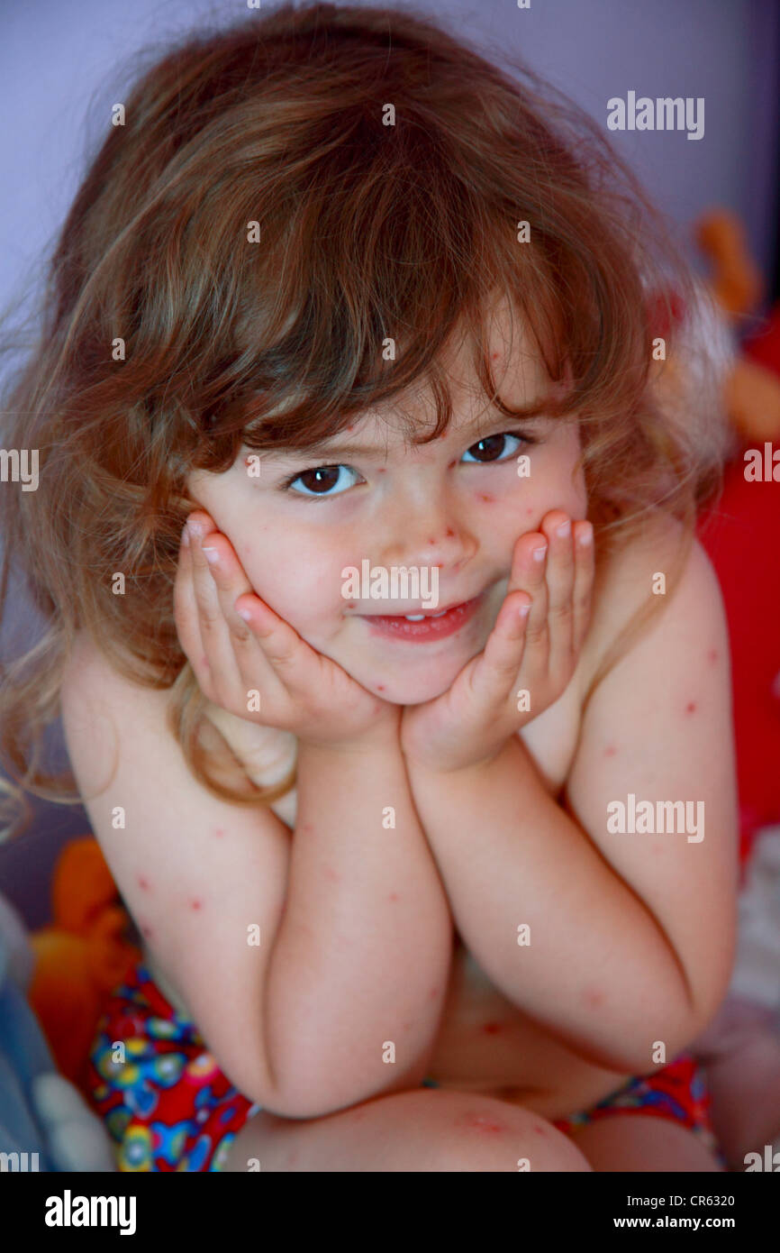 Enfant avec varicelle Banque de photographies et d’images à haute ...
