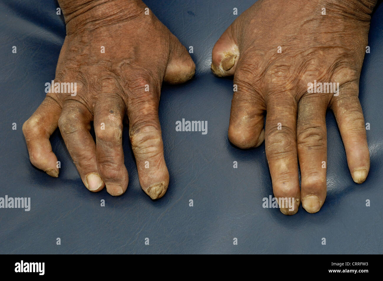 Leprosy hand Banque de photographies et d’images à haute résolution - Alamy