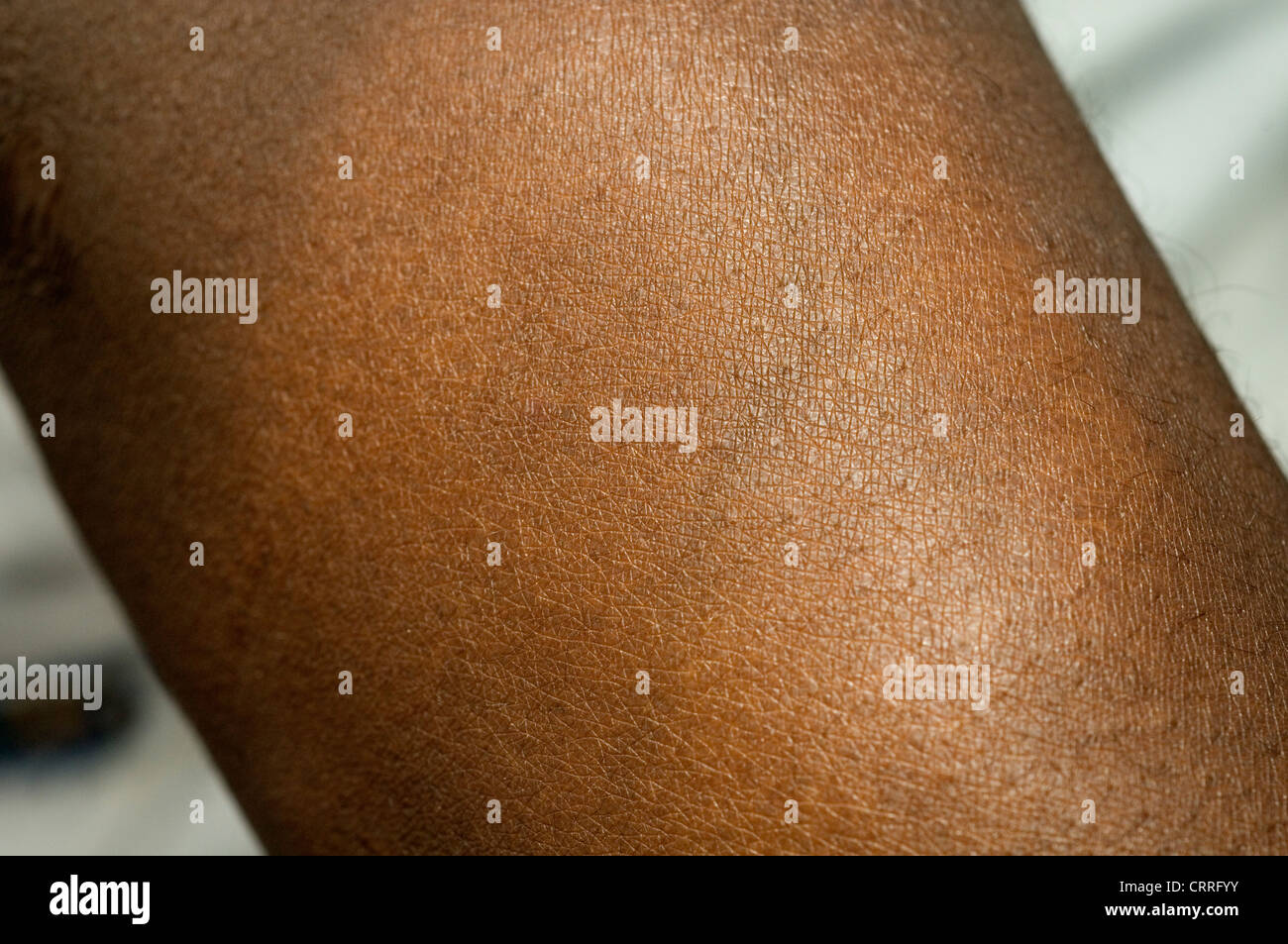 Maladie dermatologique Banque de photographies et d’images à haute ...