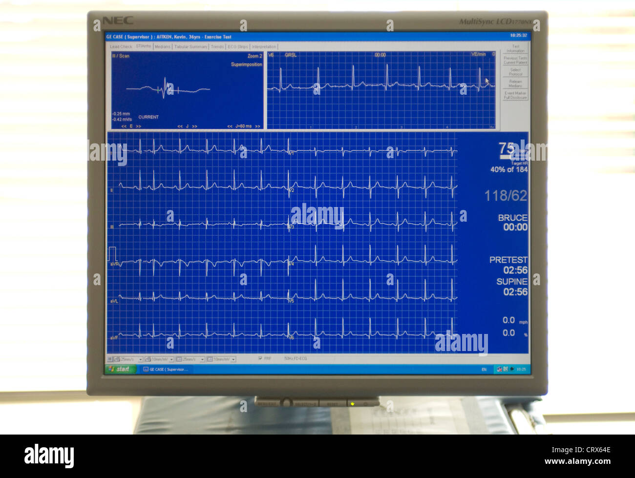 Screen of electrocardiogram monitor Banque de photographies et d’images ...