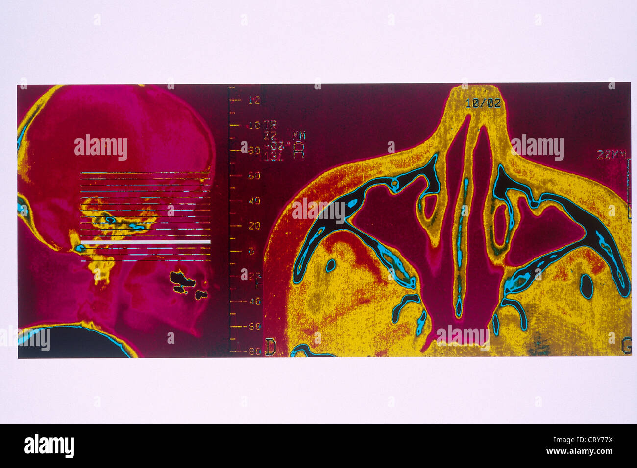 Sinus scan Banque de photographies et d’images à haute résolution - Alamy